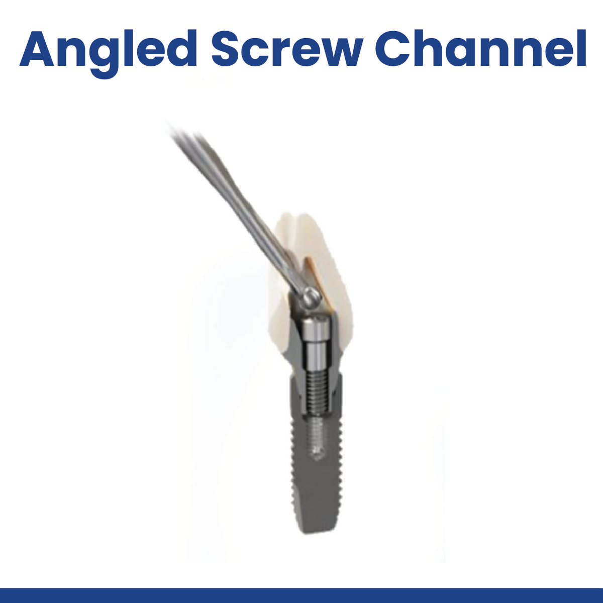 Angled Screw Channel – ARUM Milling Centre